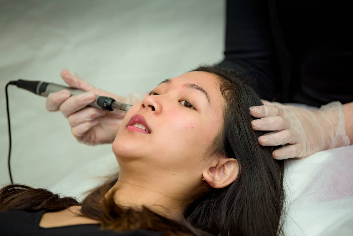 Skin Needling - Revita Medical & Skin Clinic